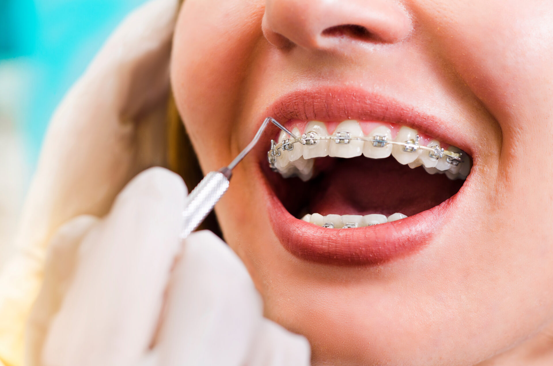 Understanding The Causes of Crooked Teeth